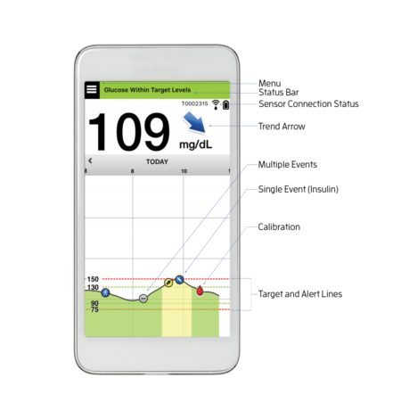 My Life-Changing Trial of the Eversense CGM - Taking Control Of Your ...