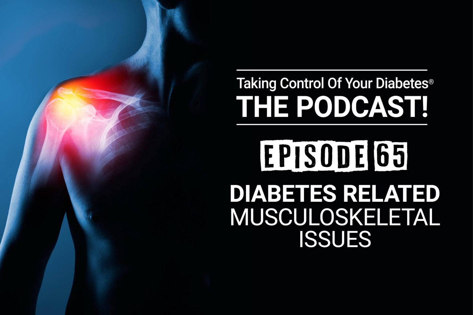 Diabetes Joint Problems: Trigger Finger & Frozen Shoulder