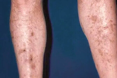 TCOYD Guide to Diabetic Dermopathy, Ulcers & Skin Care