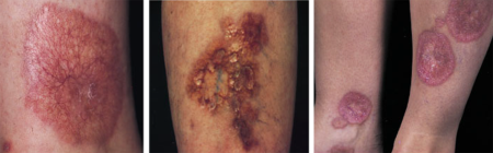 TCOYD Guide to Diabetic Dermopathy, Ulcers & Skin Care